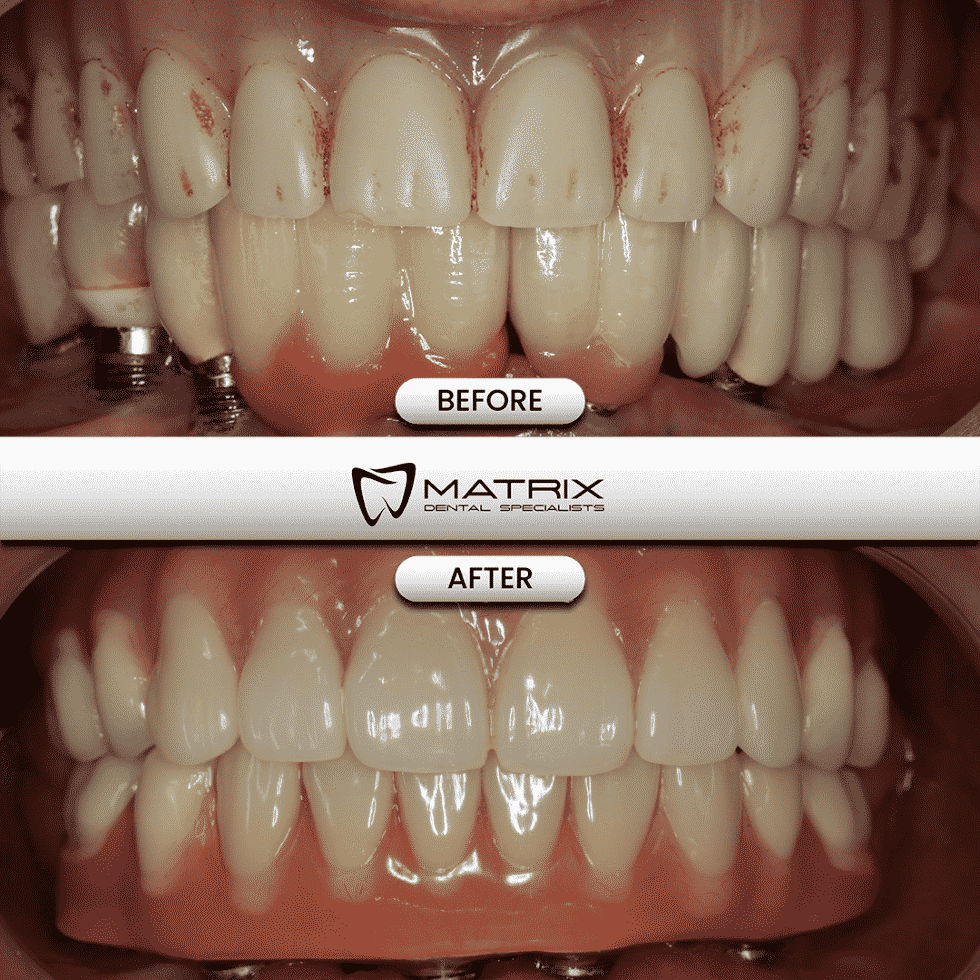 Dental Implants - Matrix Dental Specialists